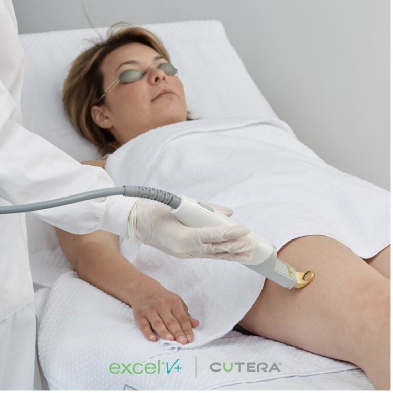What is an Excel V+ laser treatment? - KW Vein Clinic
